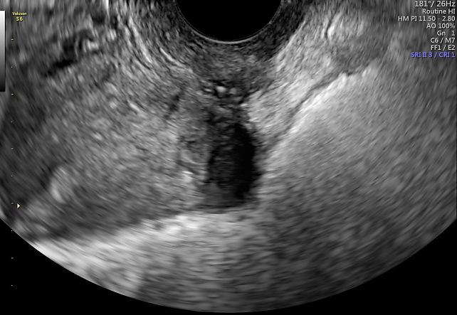 Endometriosis and Adenomyosis: Ultrasound Features and Diagnosis ...